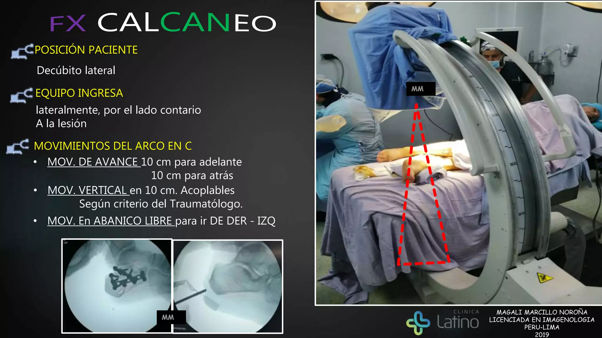 Manejo de arco en c en traumatologia | PPTX