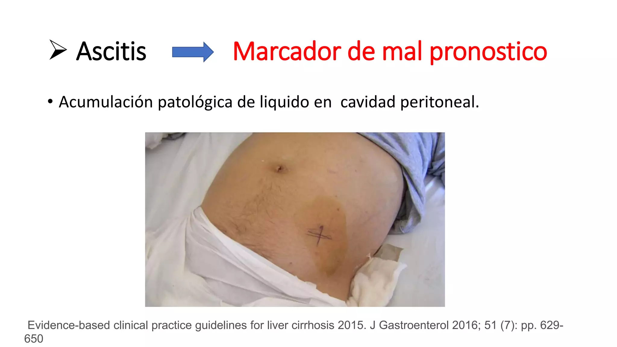 Manejo de Ascitis.pptx | Digestive Disorders | Diseases and Conditions