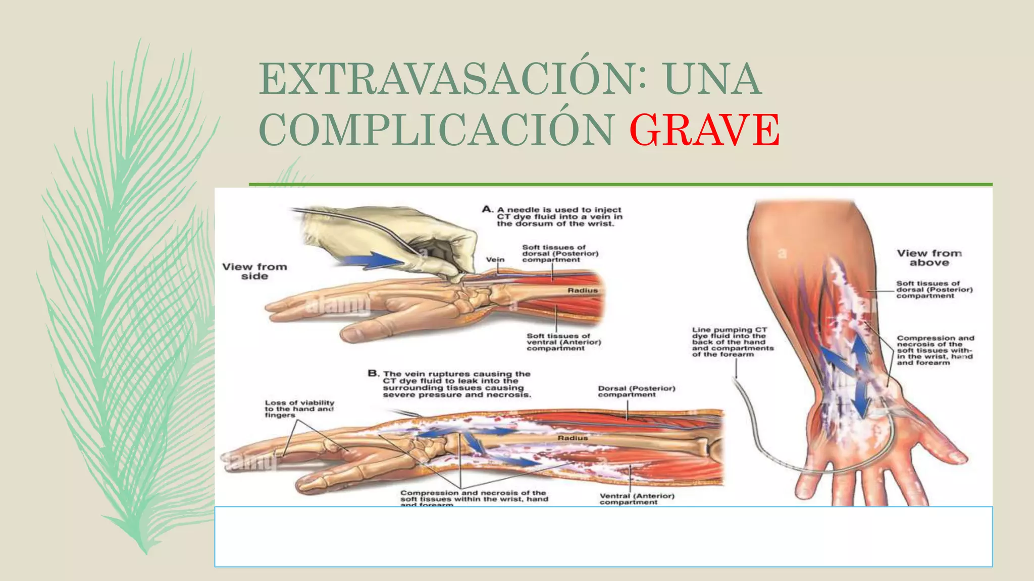MANEJO DE EXTRAVASACIÓN DE CITOSTÁTICOS.pptx