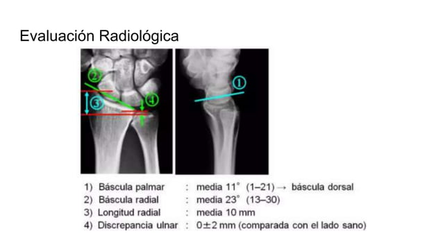 Manejo de fracturas de radio distal.pptx