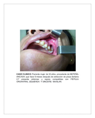 MANEJO DE LA COMUNICACIÓN Y LA FÍSTULA ORO-ANTRAL. | DOCX