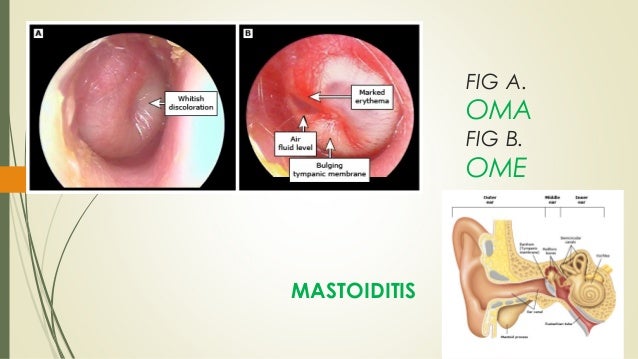 Manejo de la otitis media aguda en atención