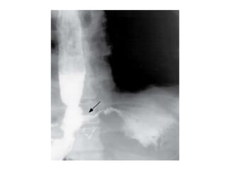 Manejo de la perforacion esofagica | PPTX
