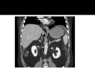 Manejo de la perforacion esofagica | PPT