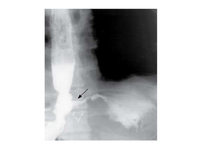 Manejo de la perforacion esofagica