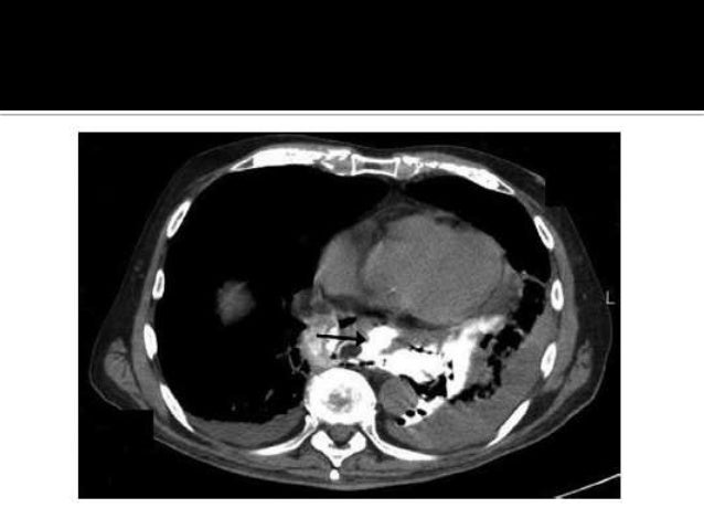 Manejo de la perforacion esofagica