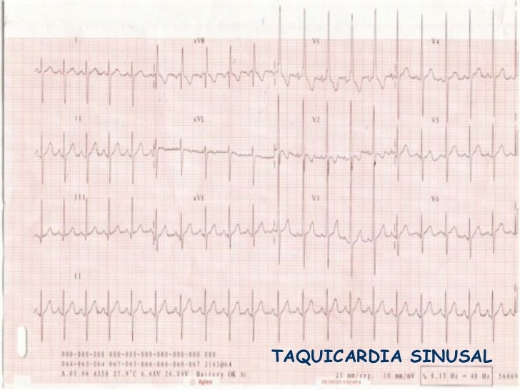 ARRITMIAS CARDIACAS EN UCIAS