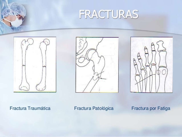 Manejo de las fracturas