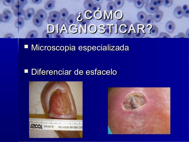 Manejo del biofilm bacteriano