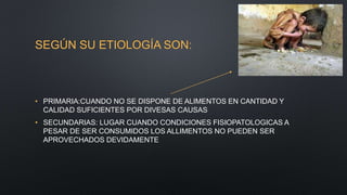 MANEJO DEL DESNUTRIDO AGUDO SEVERO [Autoguardado].pptx