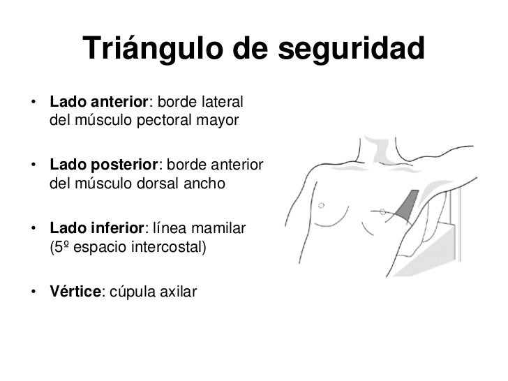 Manejo del drenaje pleural en cuidados intensivos