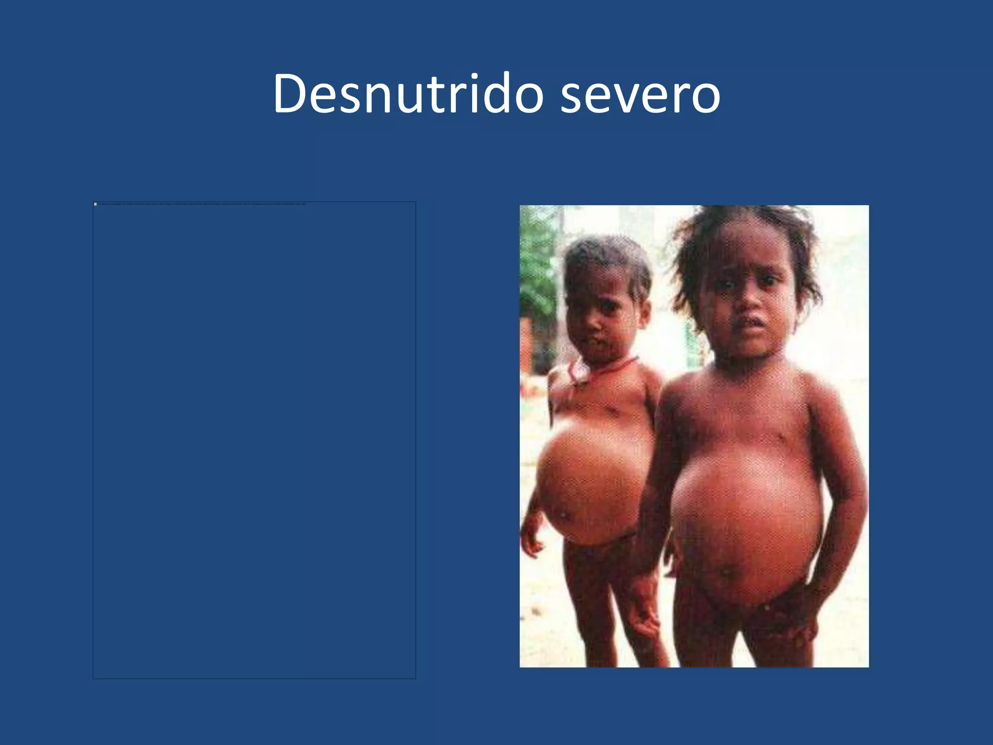 Manejo del niño desnutrido severo | PPTX