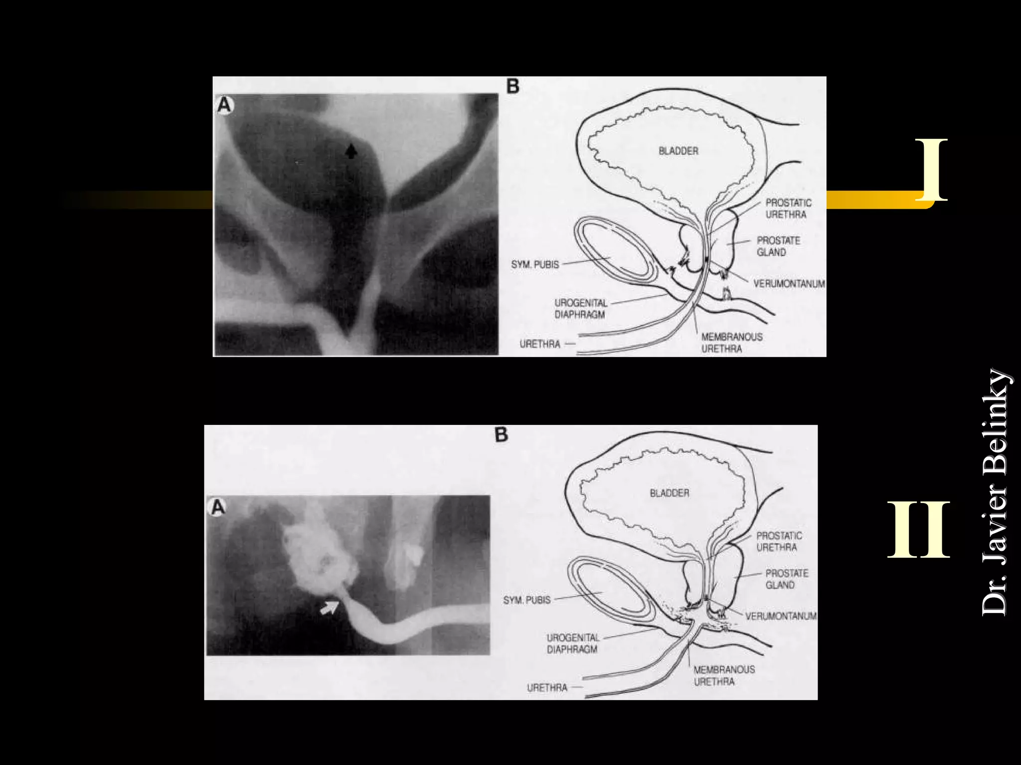Management of acute urethral trauma (Manejo del trauma uretral agudo) | PPT