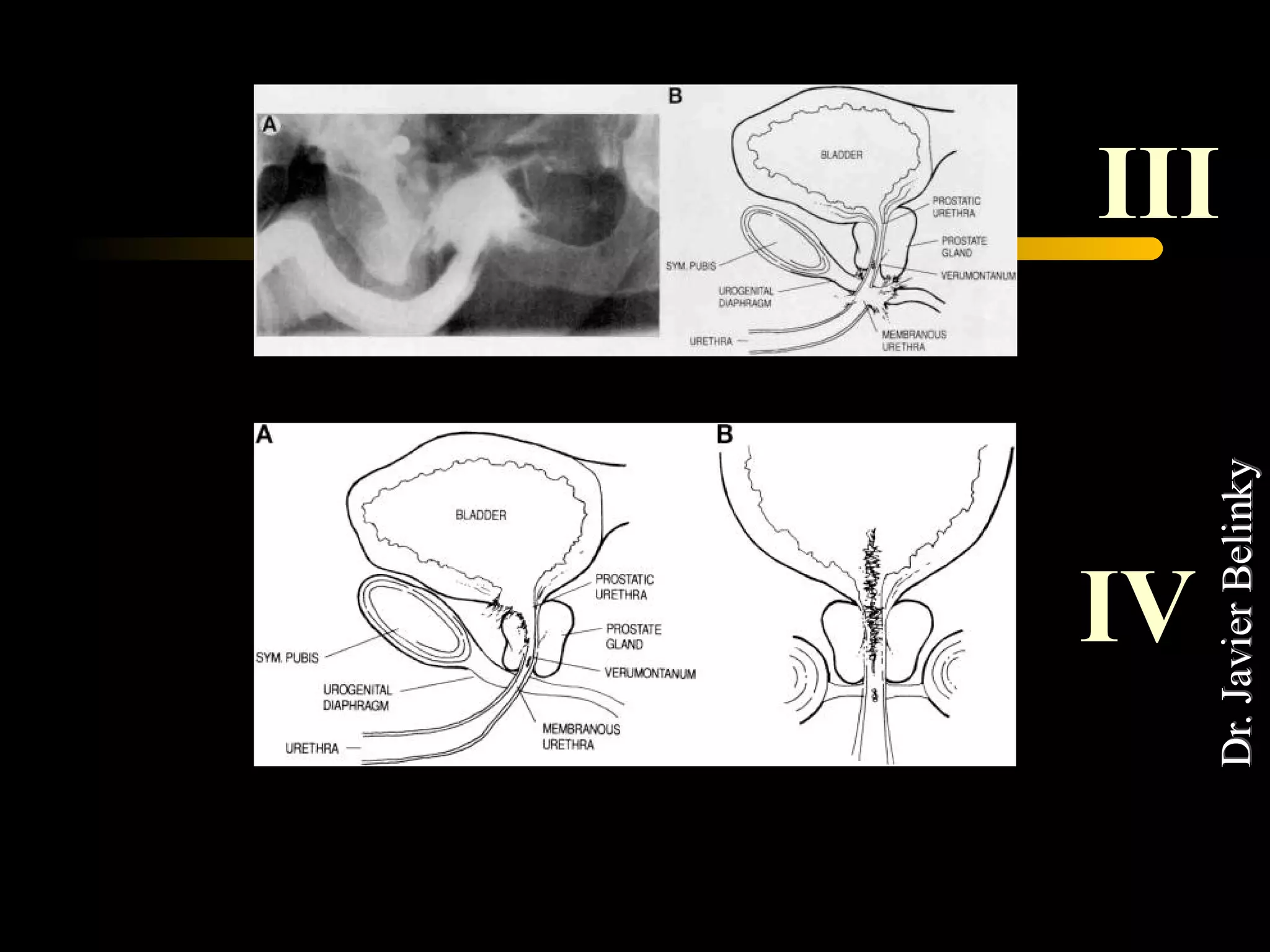 Management of acute urethral trauma (Manejo del trauma uretral agudo) | PDF