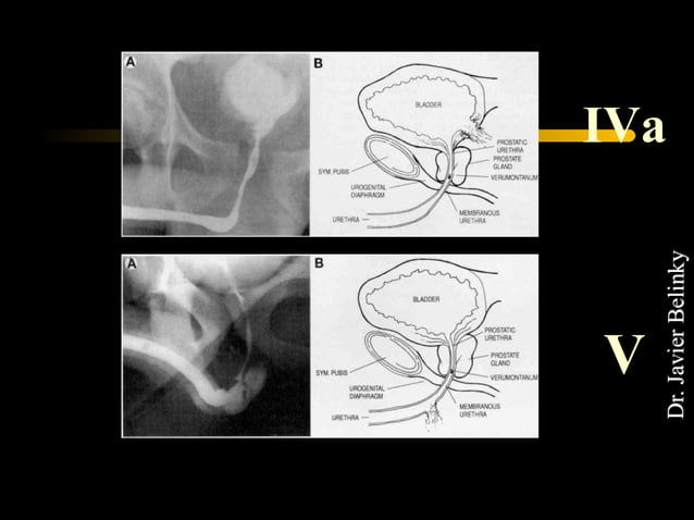 Management of acute urethral trauma (Manejo del trauma uretral agudo) | PDF