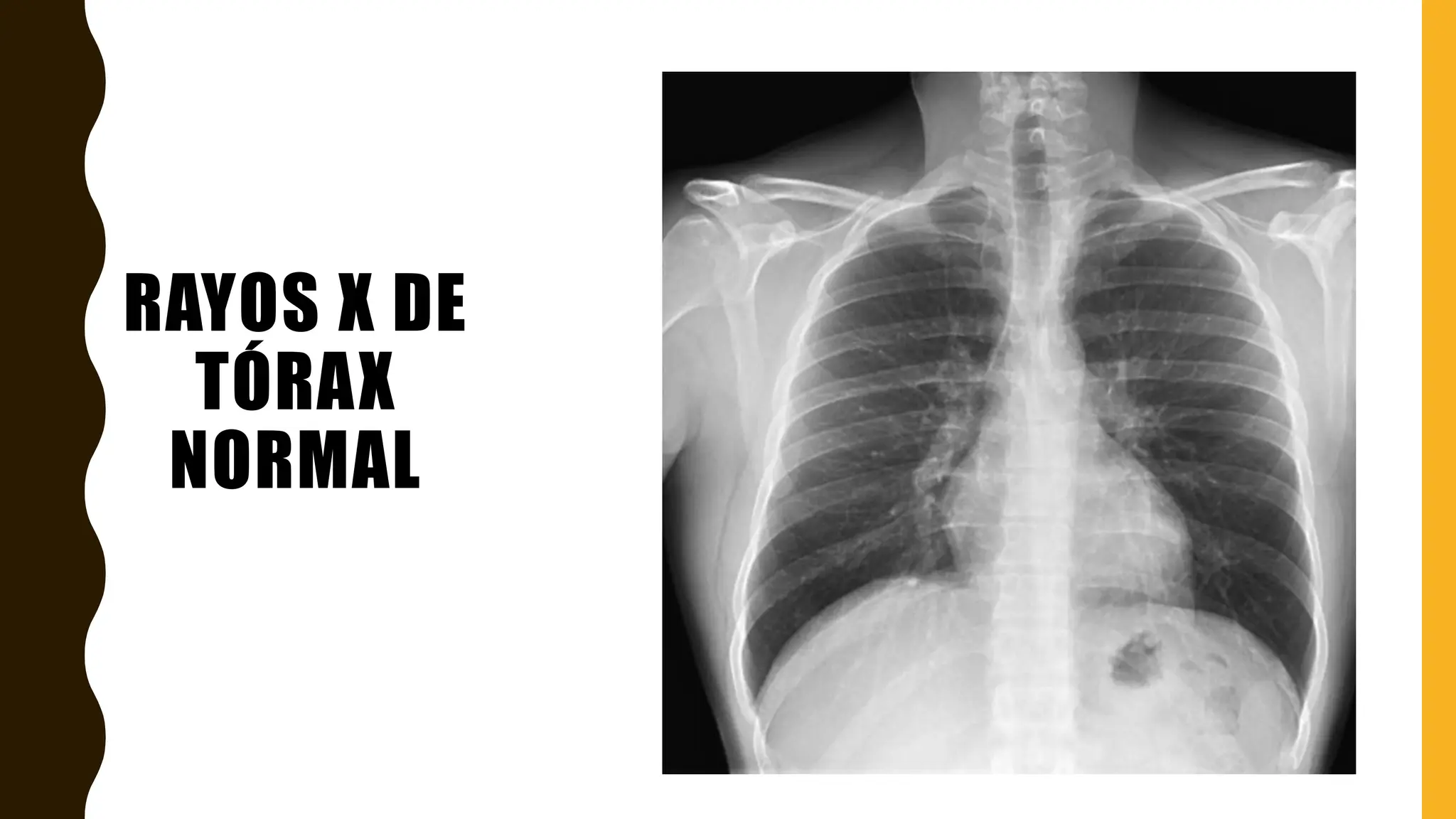 Manejo de trauma de tórax actualizado y caso | PPT