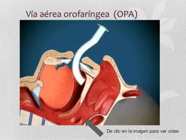 Manejo de via aerea avanzada