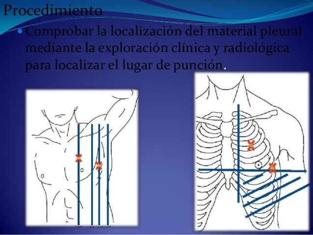 Manejo espacio pleural