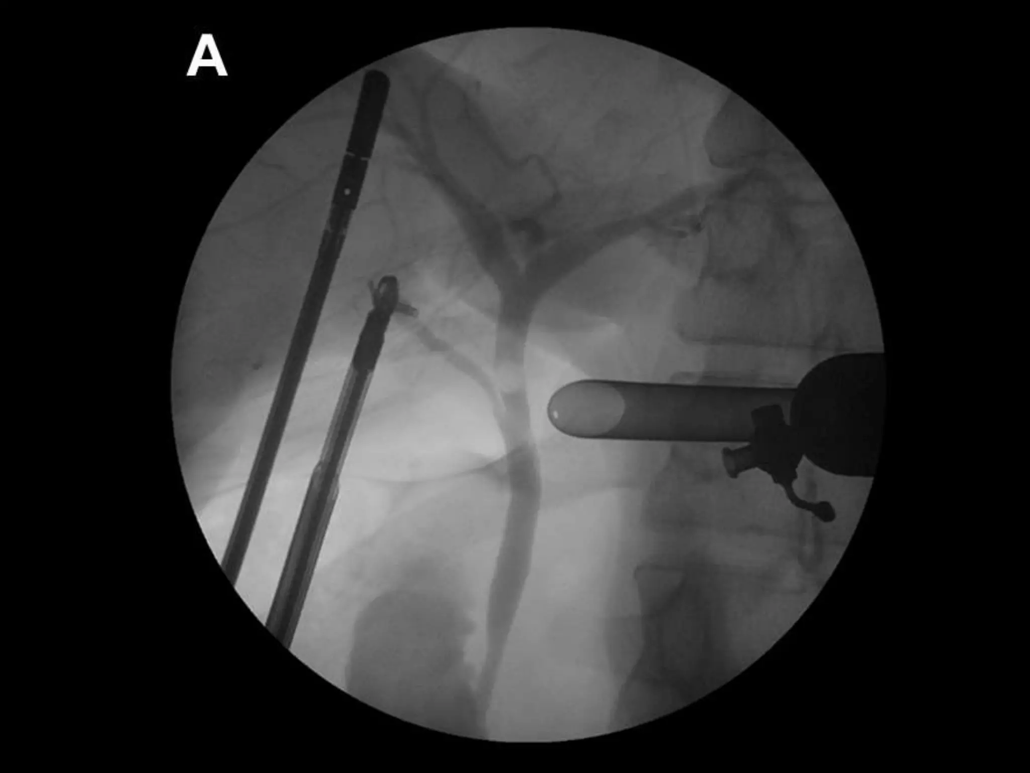 colangiografia intraoperatoria - exploración de vias biliares abierta y ...