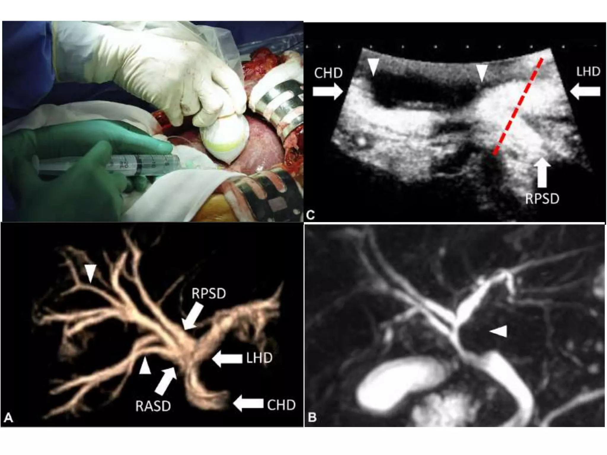 colangiografia intraoperatoria - exploración de vias biliares abierta y ...