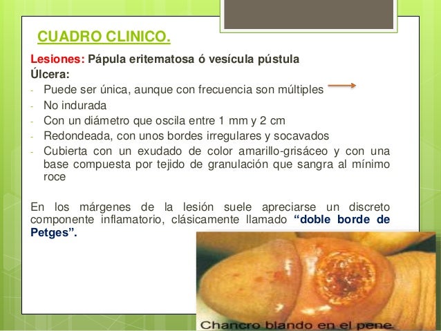 ITS Manejo sindrómico
