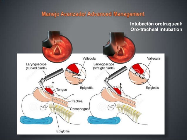 Manejo via aerea / Airway Management