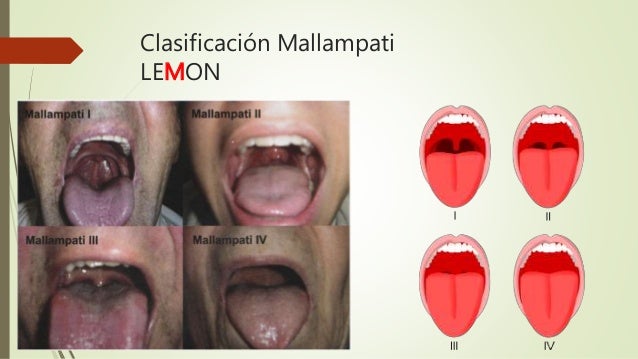 Manejo via aerea dificil