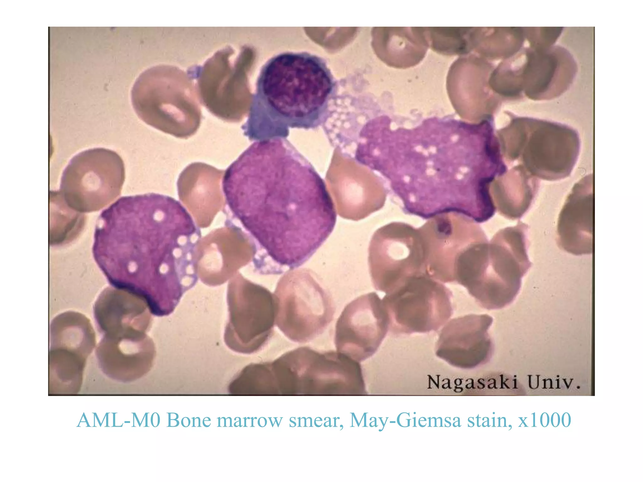 Leukemias-basic pathology | PPTX