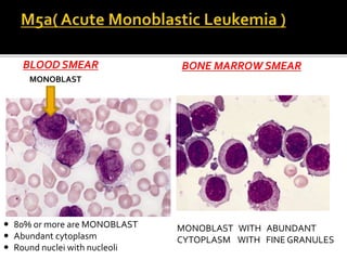 Leukemias-basic pathology | PPTX