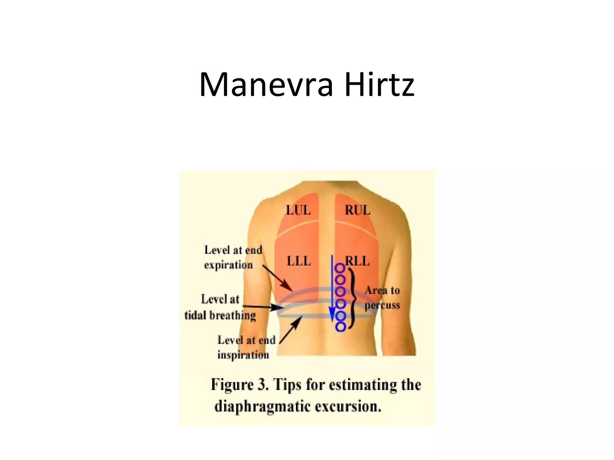 Manevra hirtz | PPT