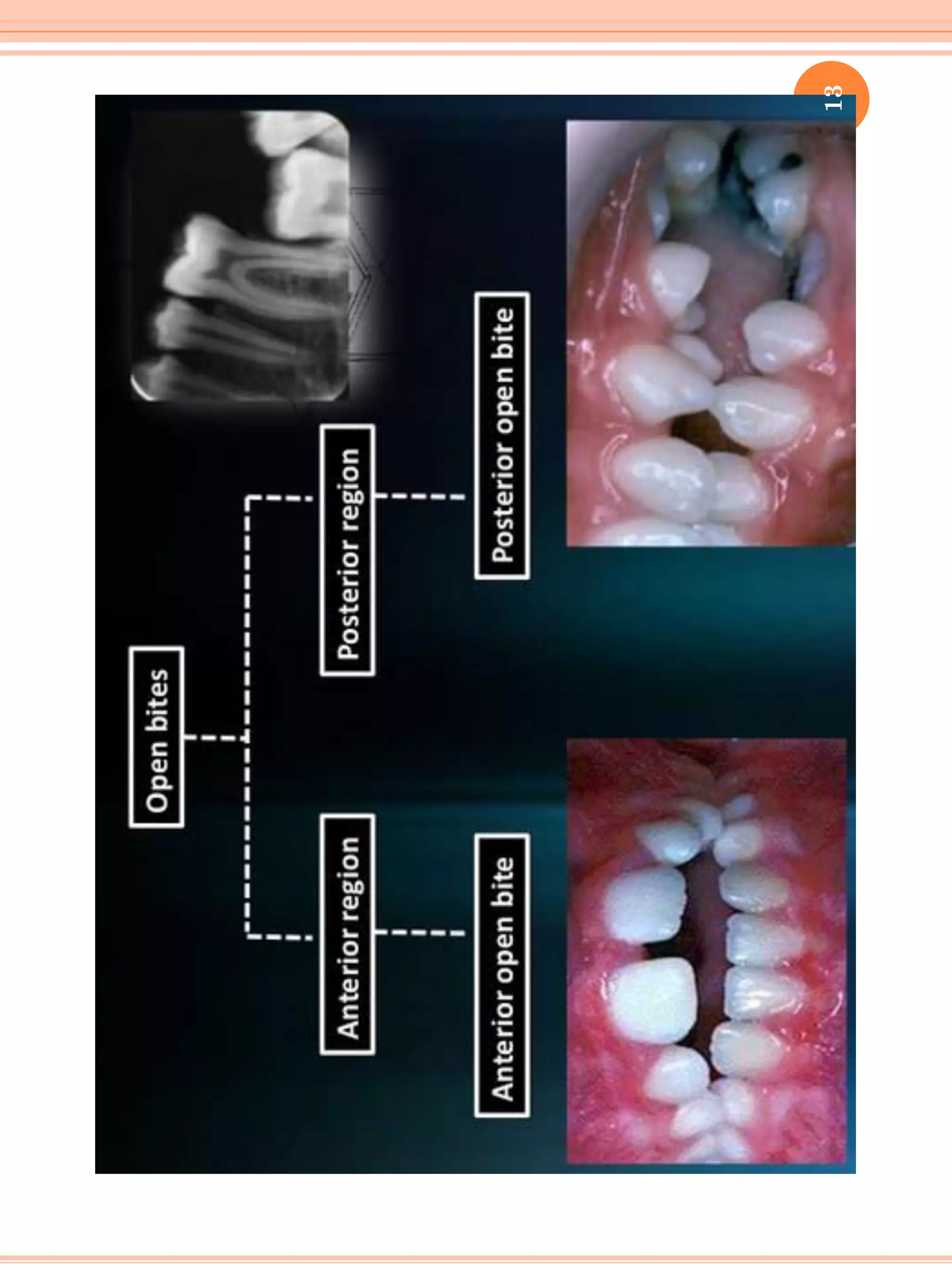 Mangement of openbite in orthodontics | PDF
