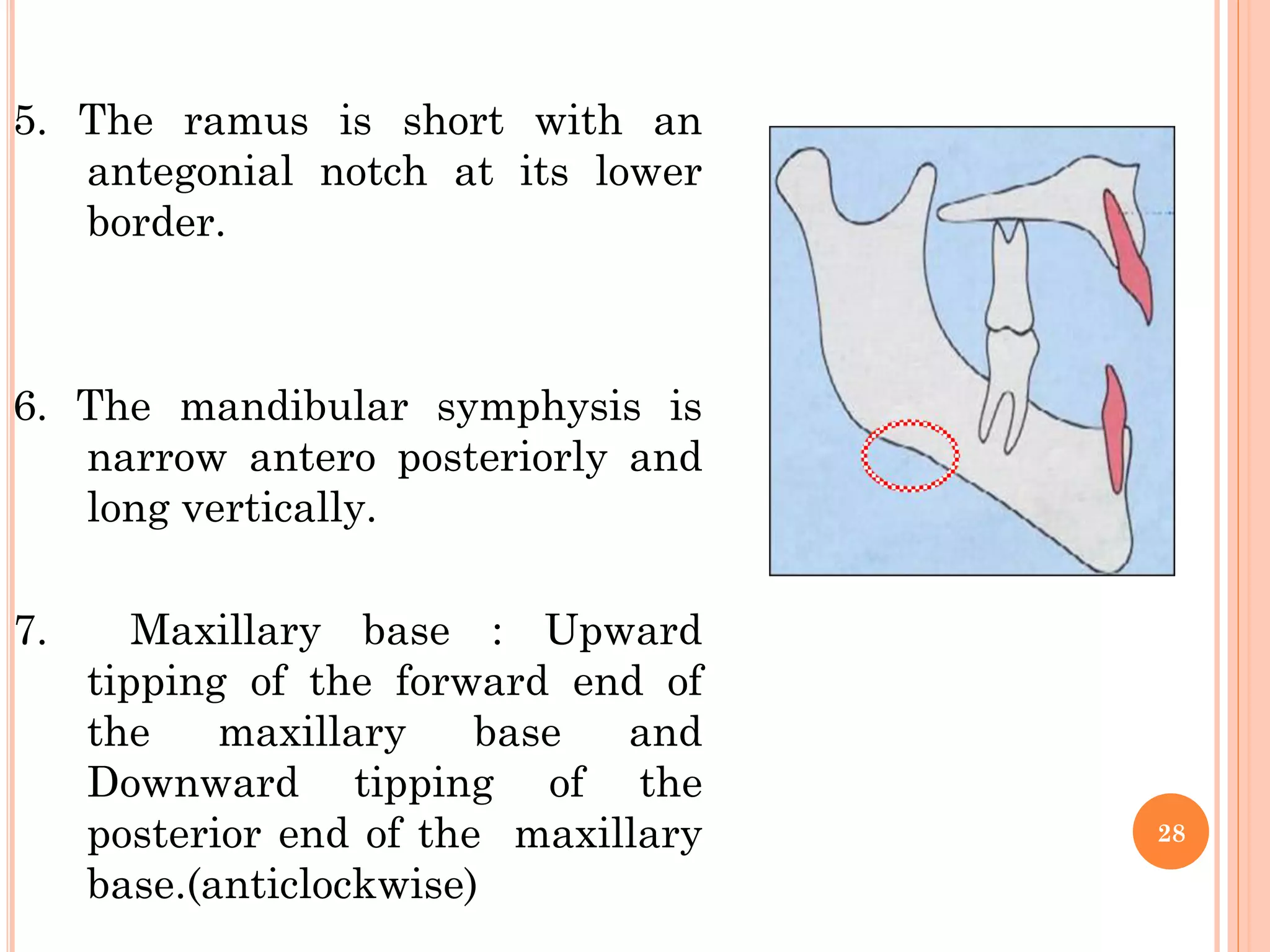 Mangement of openbite in orthodontics | PDF