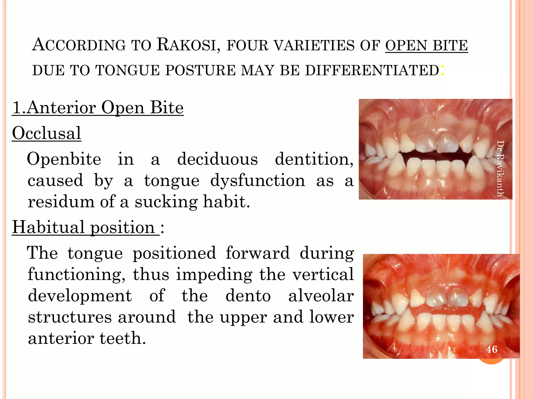 Mangement of openbite in orthodontics | PDF