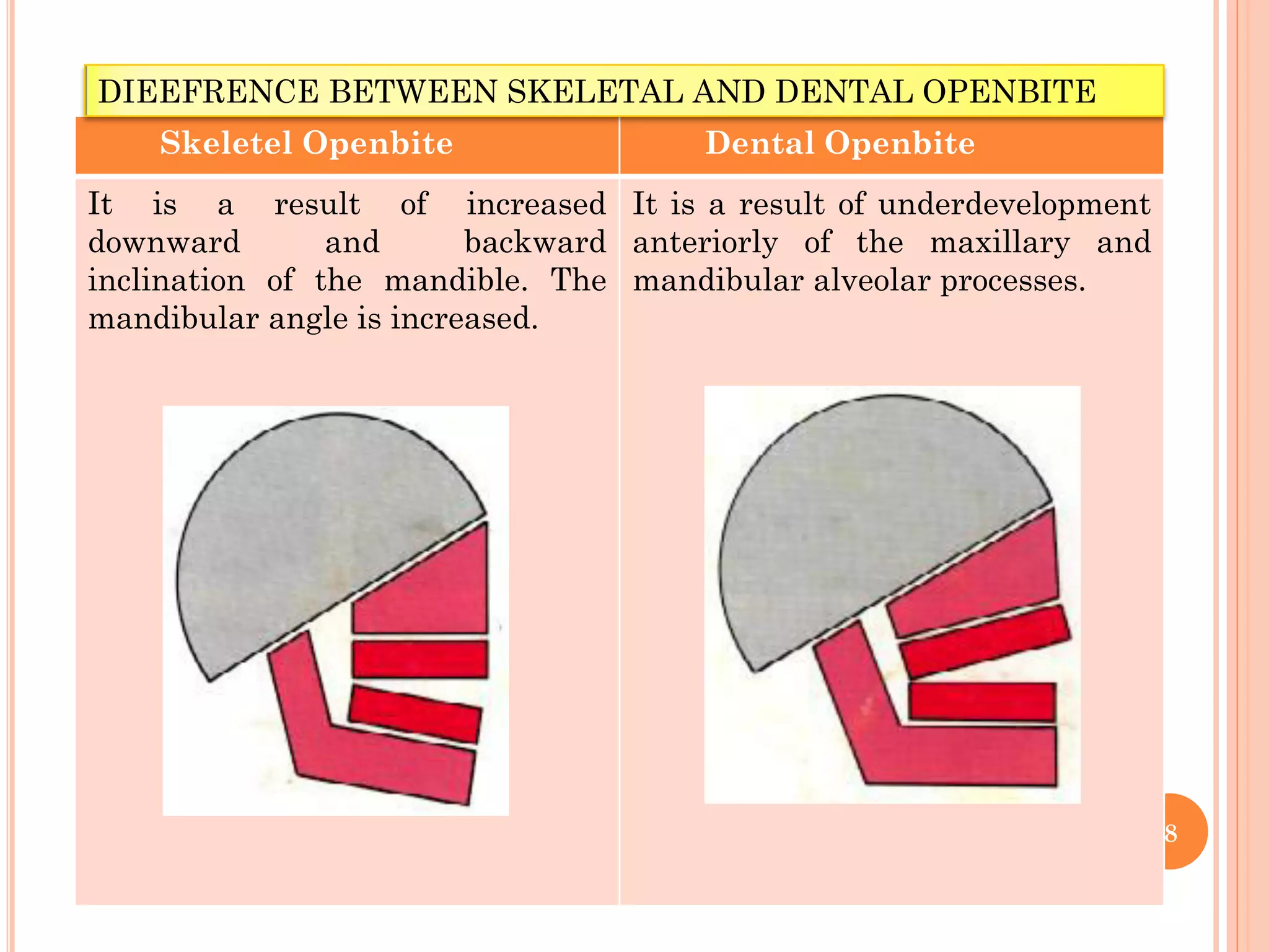 Mangement of openbite in orthodontics | PDF
