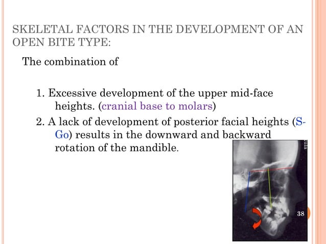 Mangement of openbite in orthodontics | PDF | Dental Health | Diseases ...