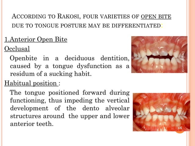Mangement of openbite in orthodontics | PDF | Dental Health | Diseases ...