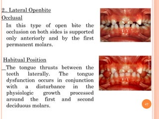 Mangement of openbite in orthodontics | PDF