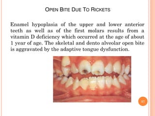 Mangement of openbite in orthodontics | PDF