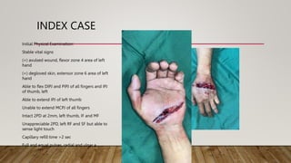 Mangled and Burned Hand.pptx