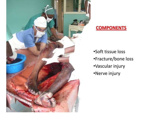 Mangled extremity | PPTX
