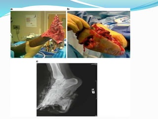 Mangled extremity and its Management | PPTX
