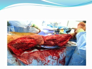 Mangled extremity and its Management | PPTX