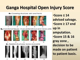 Mangled extremity and it’s management | PPTX