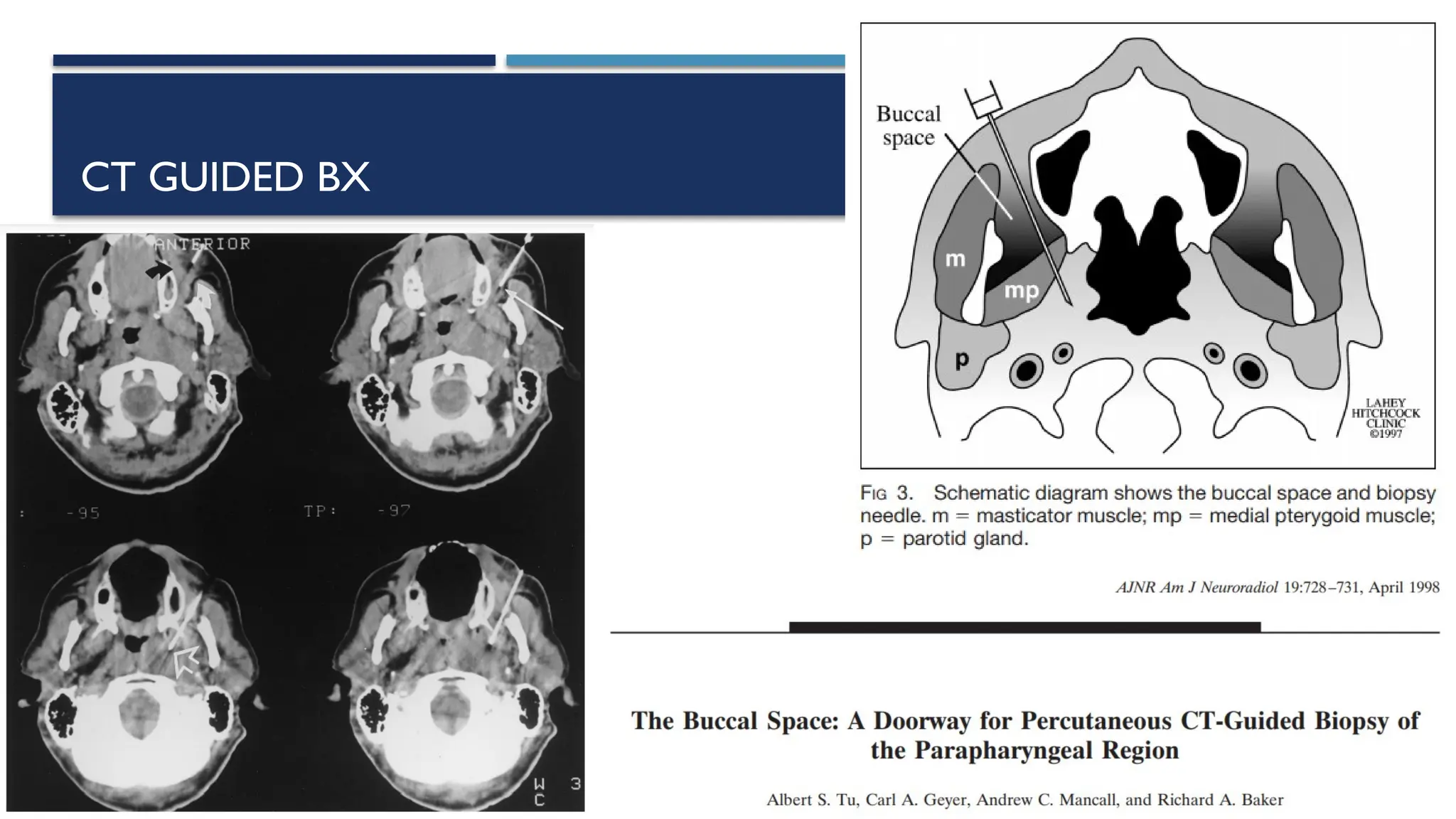 Management of parapharyngeal space tumours.pptx
