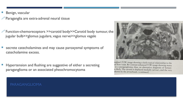 Management of parapharyngeal space tumours.pptx