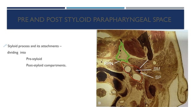 Management of parapharyngeal space tumours.pptx