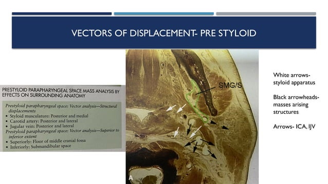 Management of parapharyngeal space tumours.pptx