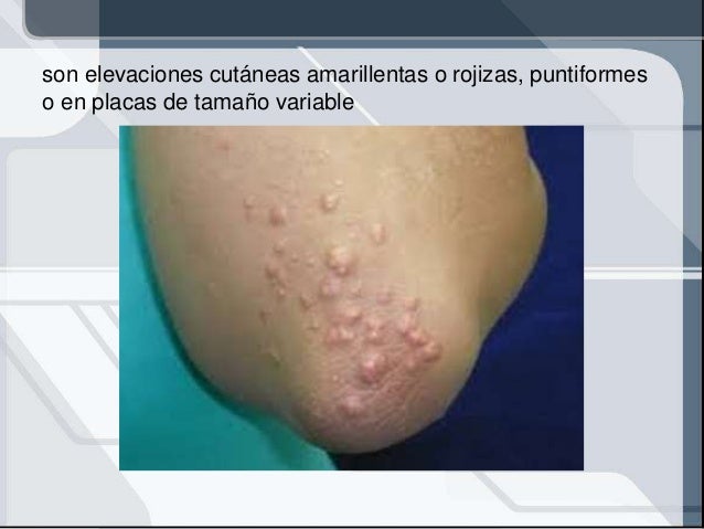 Manifestaciones cutaneas de enfermedades sistemicas