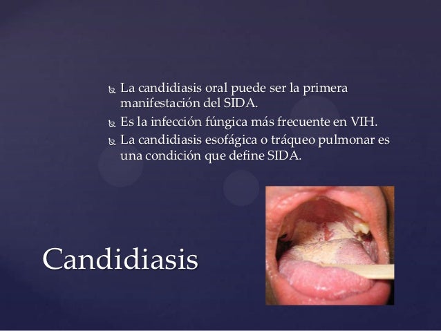 Candidiasis esofagica en vih, problemas candidiasis, yeast infection ...