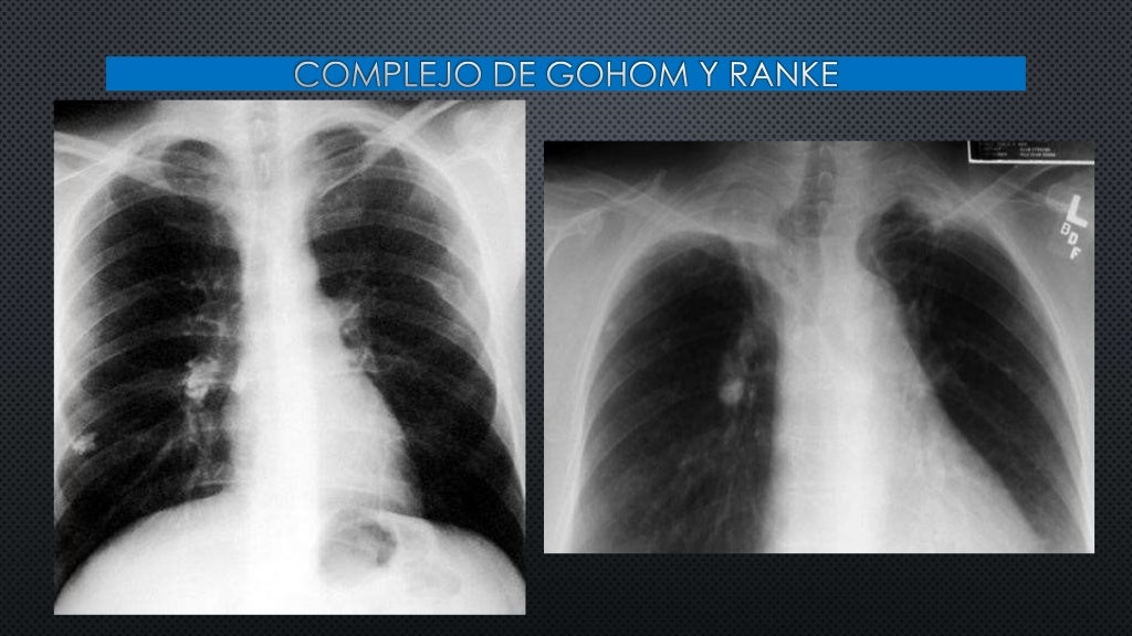 Manifestaciones radiológicas tb pulmonar